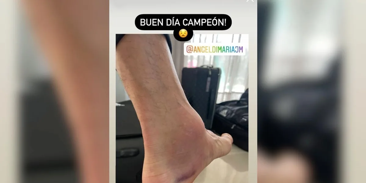 Así quedó el tobillo de Di María después de la final de la Copa América ...